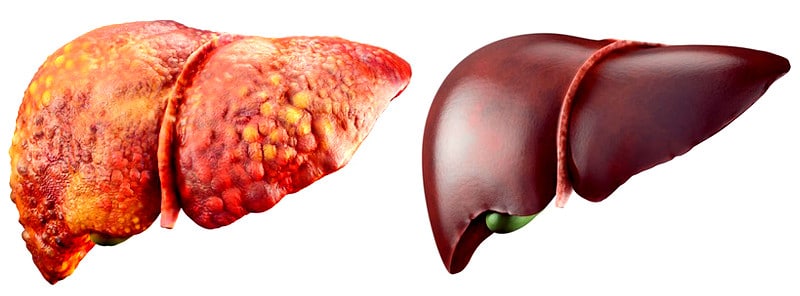 Přírodní detoxikace jater do 5 dnů za pomoci 3 přísad | Biolekar.cz